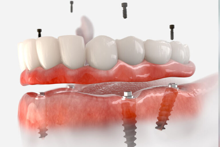 Dental Implants | Rapid City, SD | Carpenter Dental
